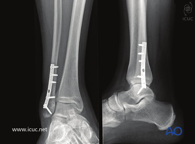 Antiglide plate for Transsyndesmotic, lateral isolated simple fracture