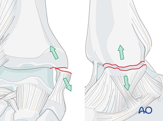Medial, transverse fracture: tension band wiring