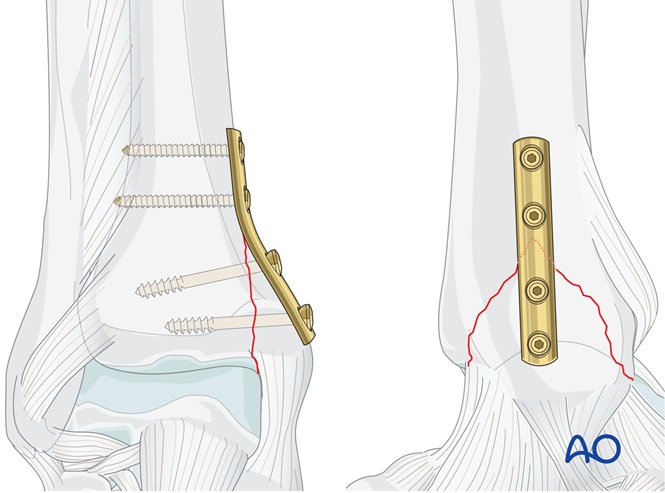 Medial, vertical fracture: lag screw through buttress plate