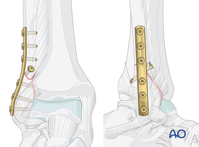 Fibula, oblique B fracture: lag screw and neutralization plate