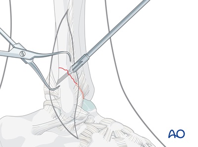 Fibula, oblique B fracture: lag screw and neutralization plate