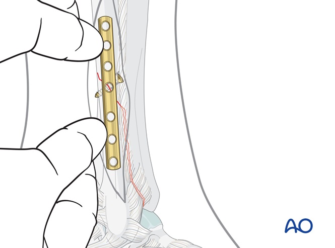 Lag screw and neutralization plate for Transsyndesmotic, lateral ...