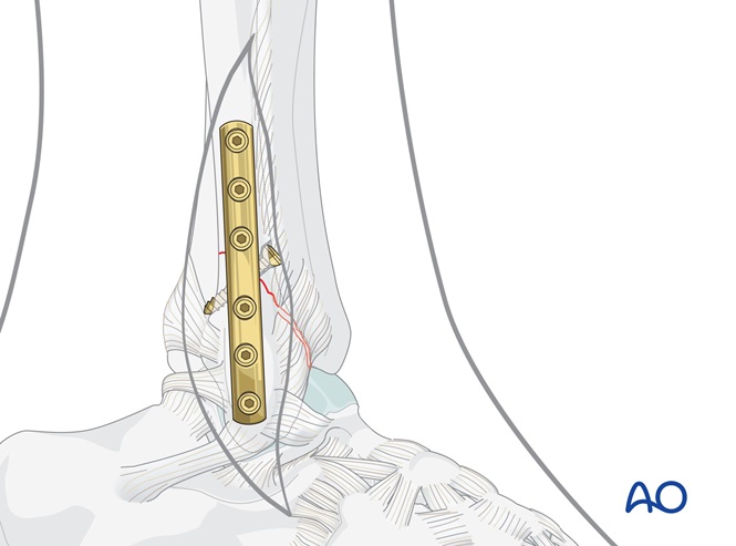 Fibula, oblique B fracture: lag screw and neutralization plate