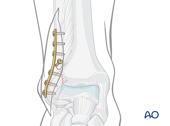 Fibula, oblique B fracture: lag screw and neutralization plate