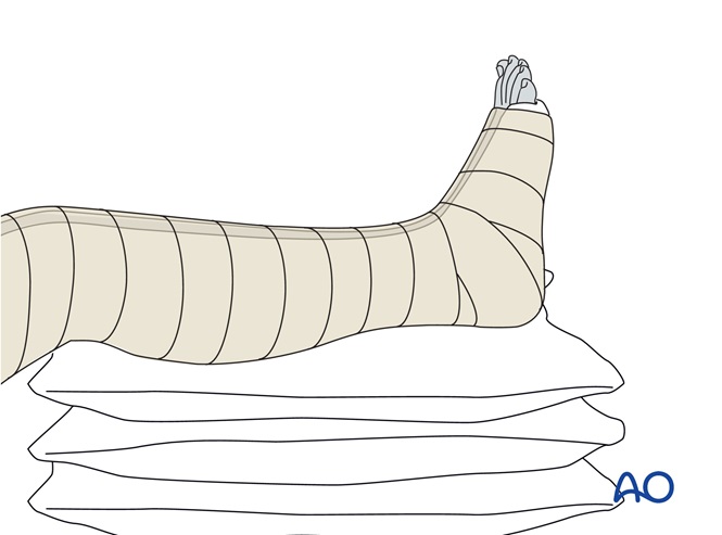 Malleoli fracture management with minimal resources