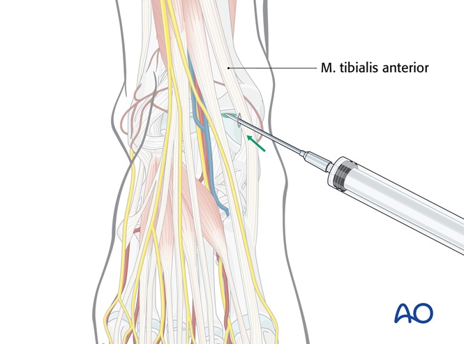 Circular cast for Infrasyndesmotic, medial fracture with LCL rupture