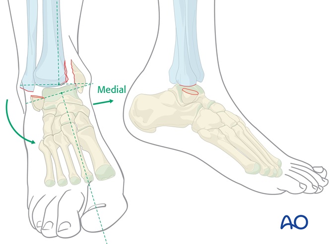 Circular cast for Infrasyndesmotic, posteromedial fracture with LCL rupture
