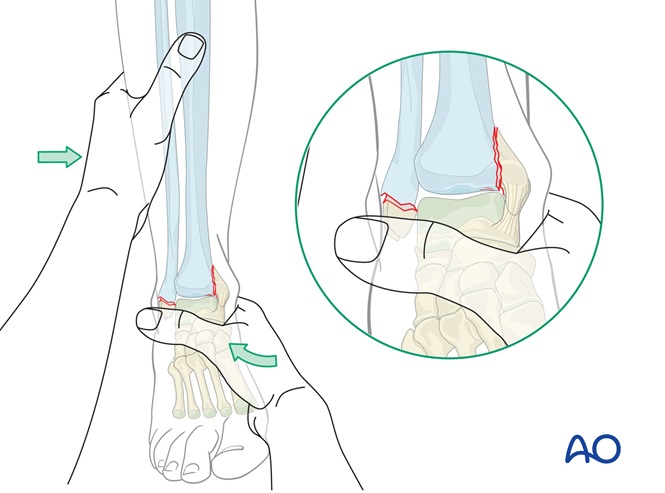 Circular cast for Infrasyndesmotic, lateral isolated ligament rupture ...