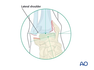 Circular cast for Infrasyndesmotic, medial fracture with LCL rupture