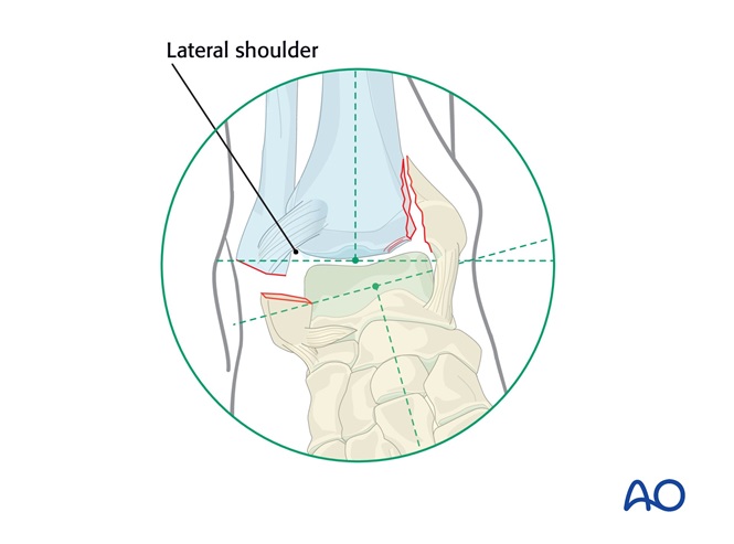 Circular cast for Infrasyndesmotic, medial fracture with LCL rupture