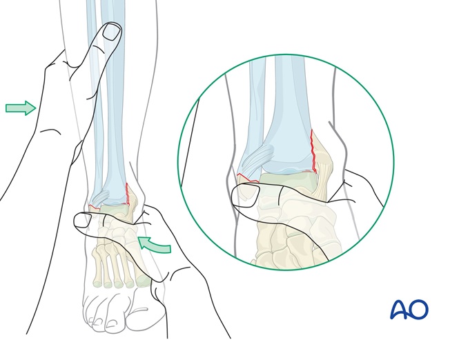 Malleoli fracture management with minimal resources