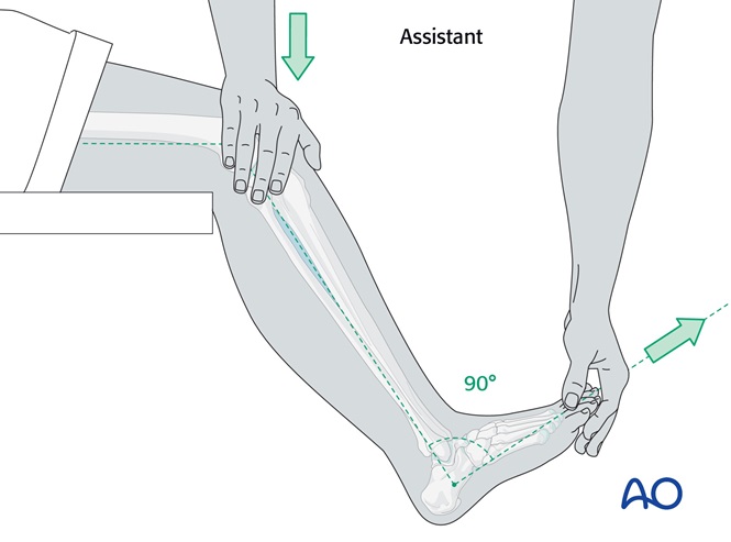 Circular cast for Infrasyndesmotic, medial fracture with LCL rupture