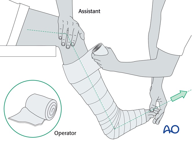 Circular cast for Transsyndesmotic, posterior, lateral simple, and ...