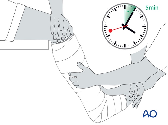 Circular cast for Infrasyndesmotic, lateral isolated ligament rupture ...