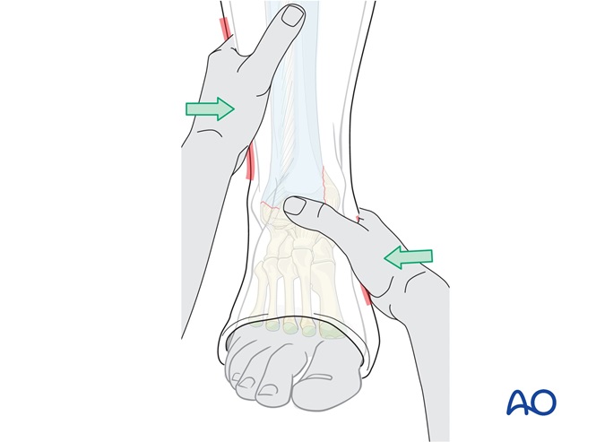 Circular cast for Infrasyndesmotic, lateral isolated fracture