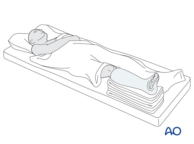 Circular cast for Infrasyndesmotic, posteromedial fracture with LCL rupture