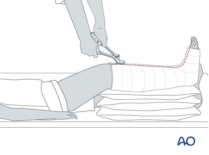 Circular cast for Infrasyndesmotic, medial fracture with LCL rupture