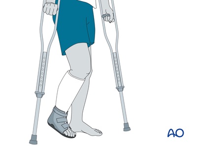 Circular cast for Transsyndesmotic, lateral isolated simple fracture