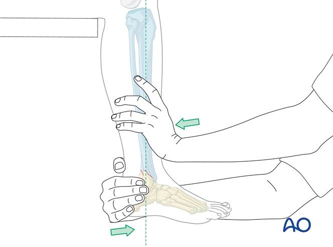Circular cast for Transsyndesmotic, posterior, lateral simple, and ...