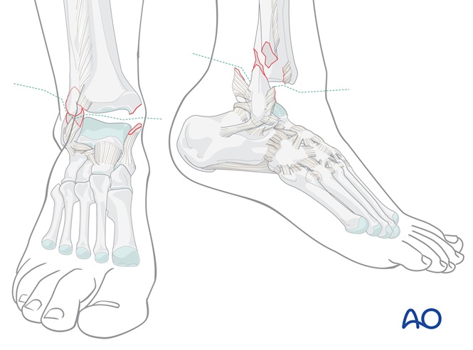 Malleoli fracture management with minimal resources