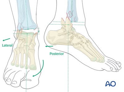 Circular cast for Transsyndesmotic, lateral isolated simple fracture