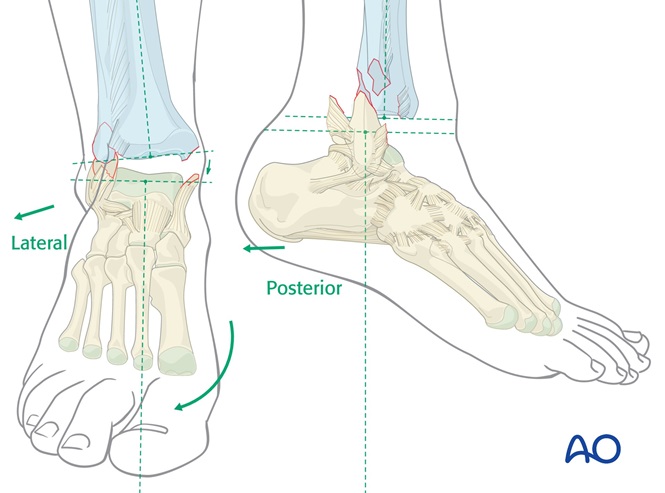Circular cast for Transsyndesmotic, lateral multifragmentary fracture ...