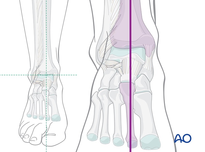 Circular cast for Transsyndesmotic, posterior, lateral simple, and ...