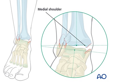Malleoli fracture management with minimal resources