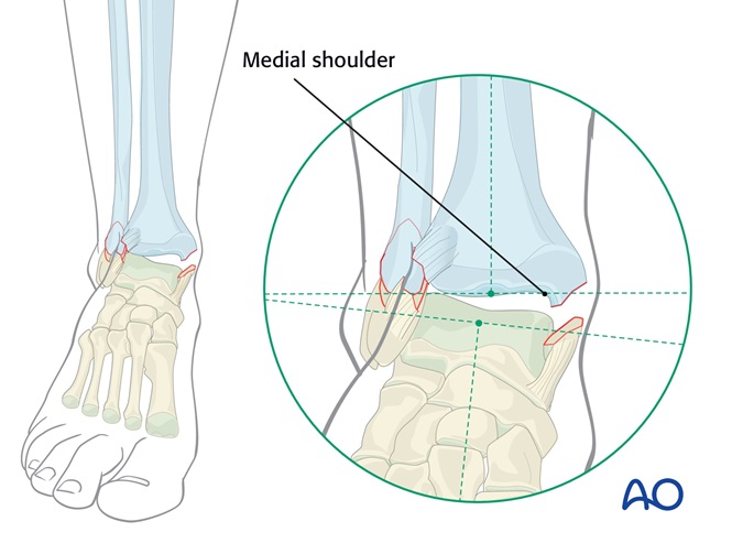 Malleoli fracture management with minimal resources