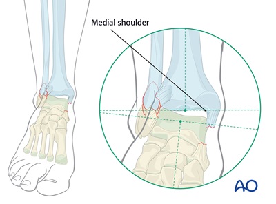 Circular cast for Transsyndesmotic, lateral isolated simple fracture
