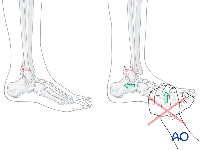 Malleoli fracture management with minimal resources