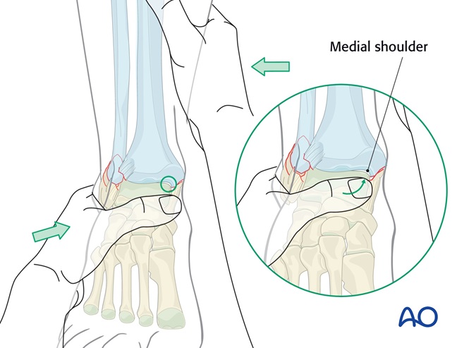 Malleoli fracture management with minimal resources