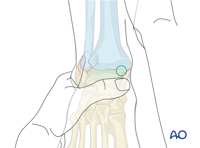Malleoli fracture management with minimal resources