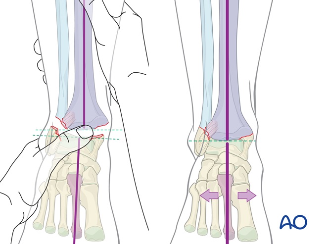 Circular cast for Transsyndesmotic, posterior, lateral simple, and ...