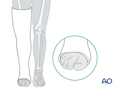 Circular cast for Transsyndesmotic, lateral isolated simple fracture