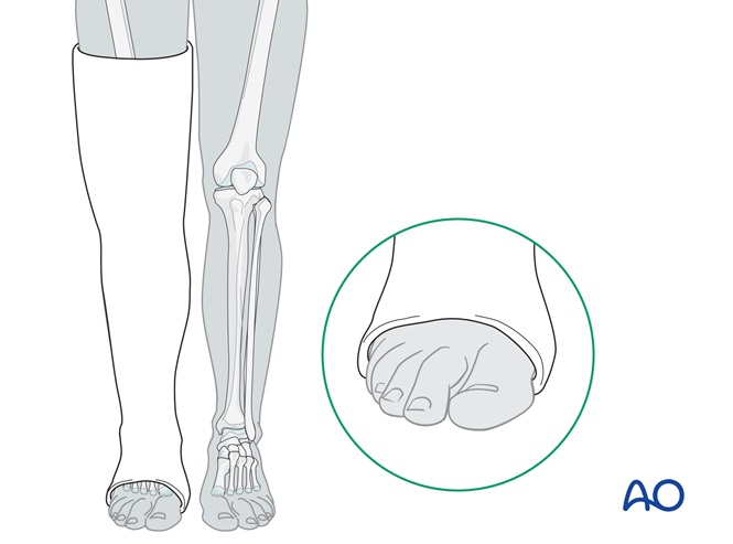 Circular cast for Transsyndesmotic, posterior, lateral simple, and ...