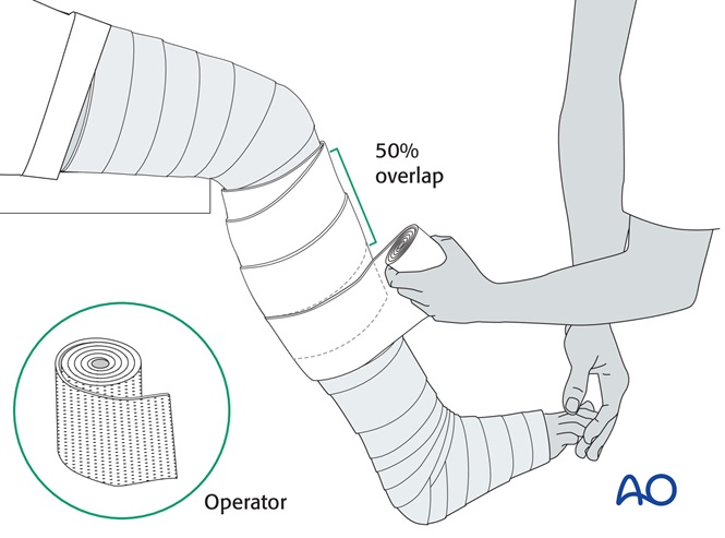 Circular cast for Transsyndesmotic, posterior, lateral simple, and ...
