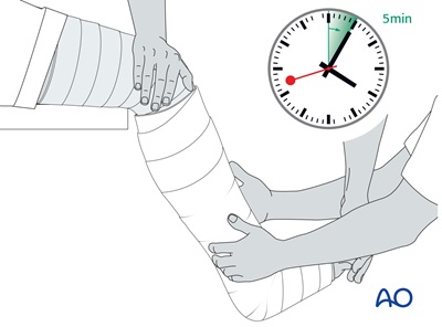 Circular cast for Transsyndesmotic, lateral isolated simple fracture