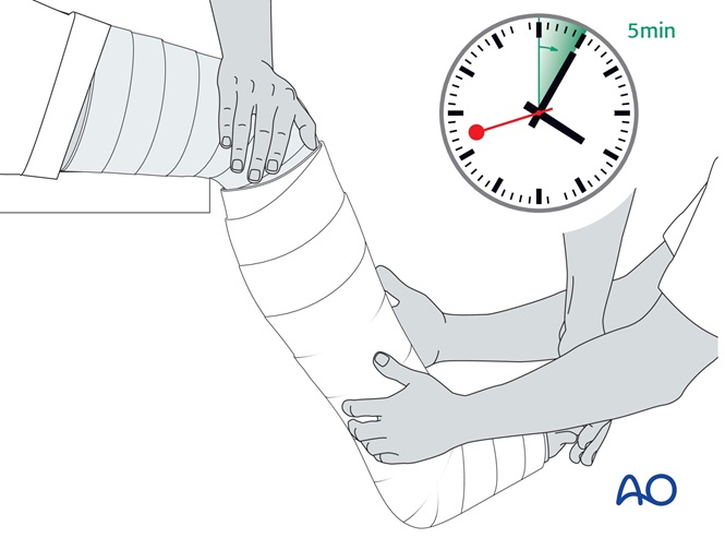Circular cast for Transsyndesmotic, posterior, lateral simple, and ...