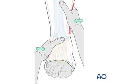 Circular cast for Transsyndesmotic, lateral isolated simple fracture