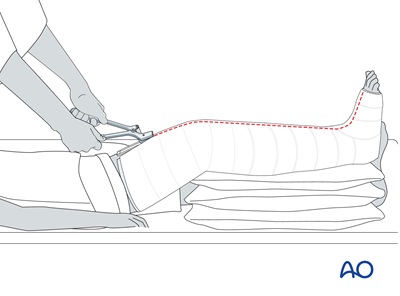 Circular cast for Transsyndesmotic, lateral isolated simple fracture