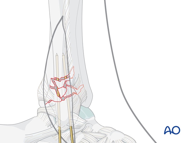 Fibula, multifragmentary fracture: lateral bridging plate