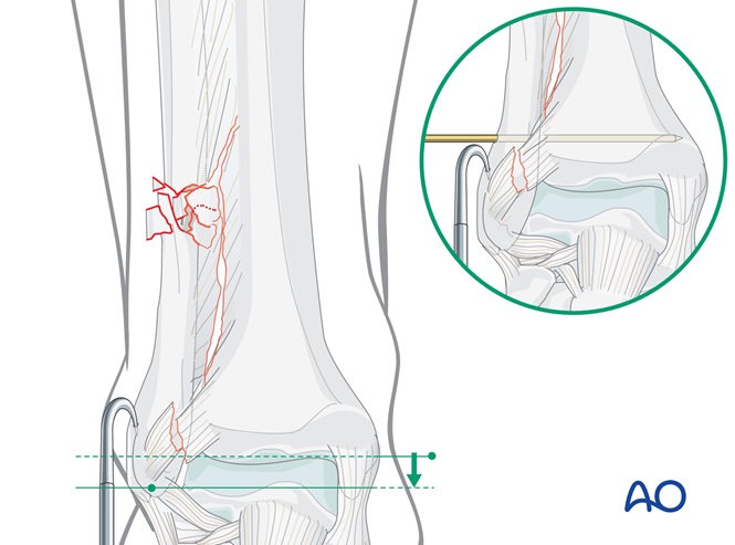 Fibula, multifragmentary fracture: lateral bridging plate