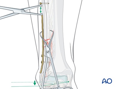 Fibula, multifragmentary fracture: lateral bridging plate