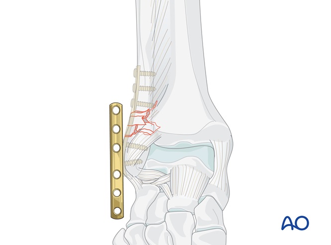 Bridging plate for Transsyndesmotic, lateral isolated multifragmentary ...