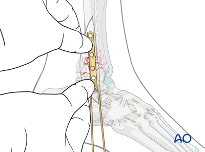 Bridging plate for Transsyndesmotic, lateral isolated multifragmentary ...
