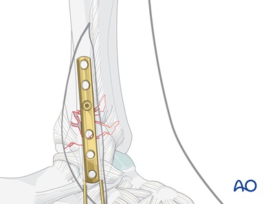 Fibula, multifragmentary fracture: lateral bridging plate