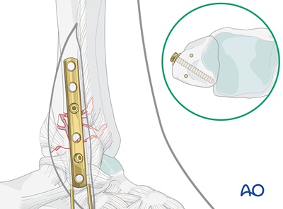 Bridging plate for Transsyndesmotic, lateral isolated multifragmentary ...