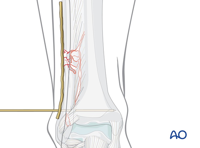 Fibula, multifragmentary fracture: lateral bridging plate