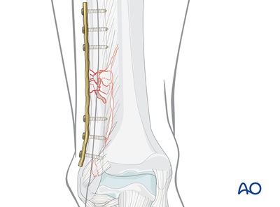 Fibula, multifragmentary fracture: lateral bridging plate
